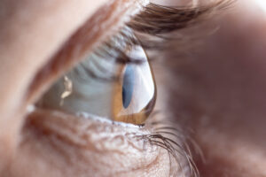 Understanding the Different Types of Corneal Disease